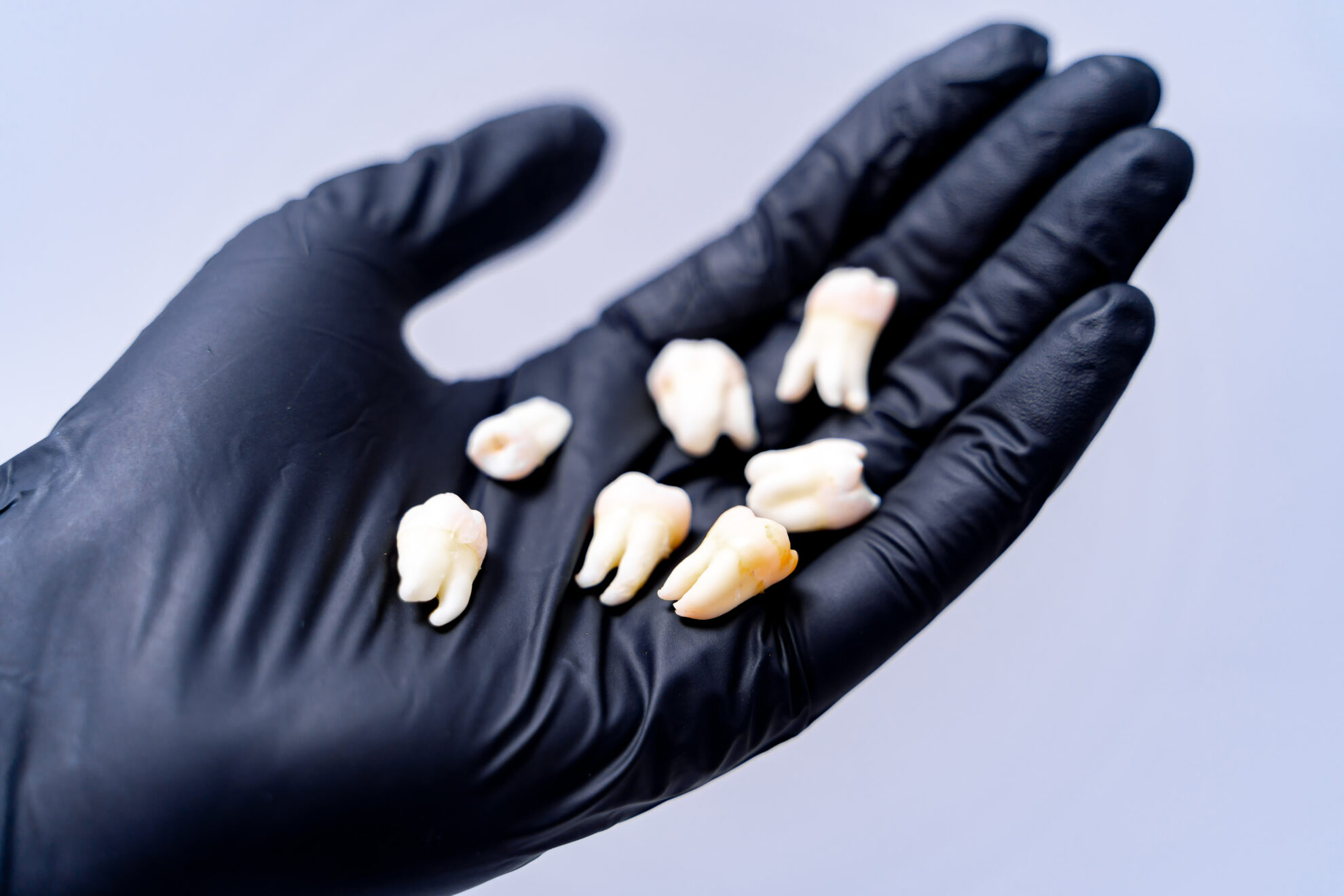 Extracción de muelas | Clínica dental Brident odontólogos Tenerife