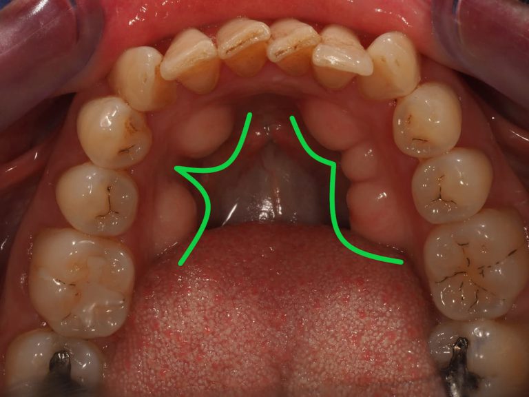 Torus mandibular. ¿Qué es y cuáles son sus causas?