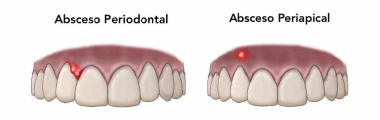 ¿Qué es un absceso dental, síntomas y cura?